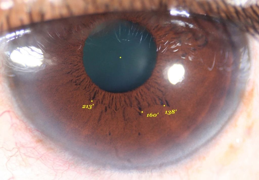 What Are Nerve Rings in Iridology?